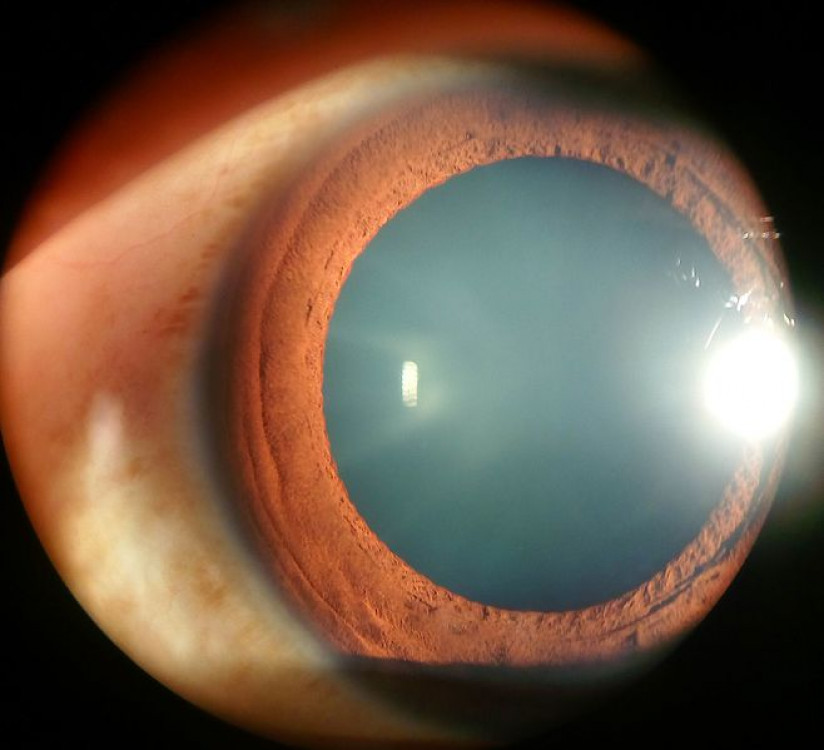 Principles of Optics and Refraction - PREP Duke Elder