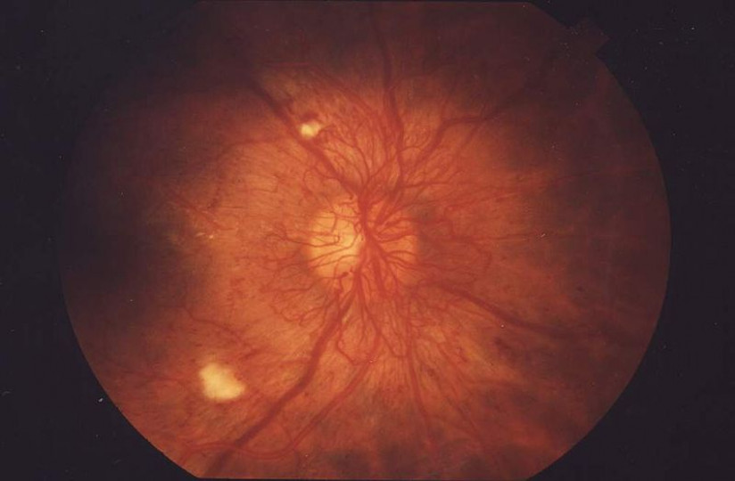 Retinal Vascular Diseases - PREP Duke Elder