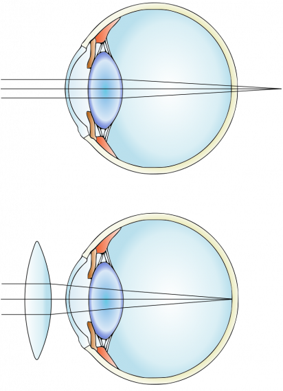 Refractive Errors - PREP Duke Elder