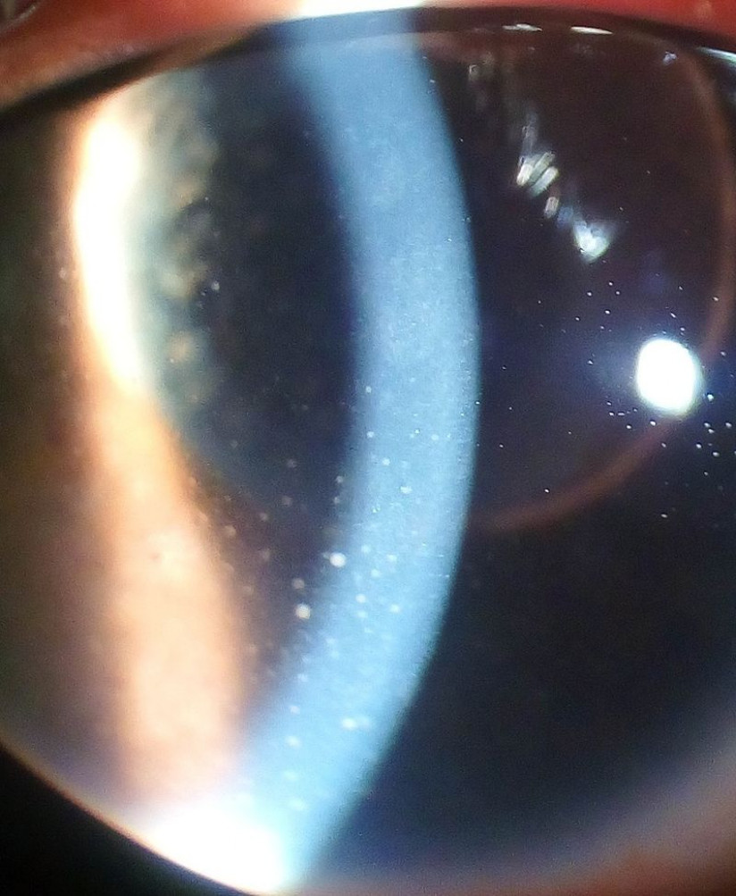 Uveitis - PREP Duke Elder