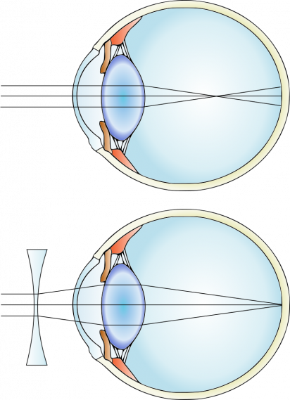 Refractive Errors - PREP Duke Elder