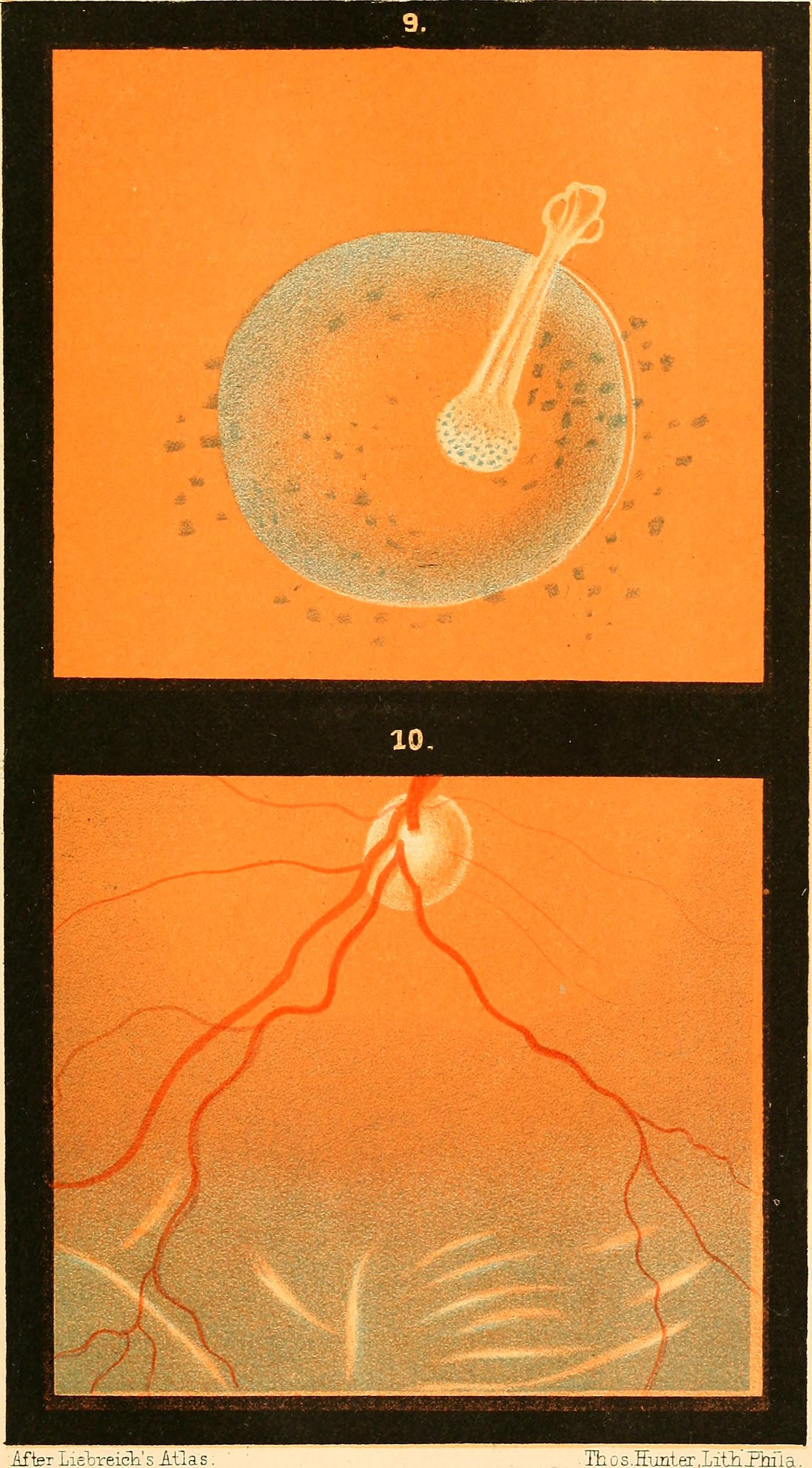 Vitreo-Retinal Interface disorders - PREP Duke Elder