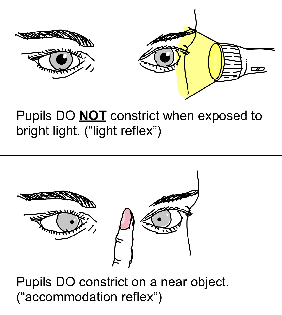 Pupil Abnormalities - PREP Duke Elder