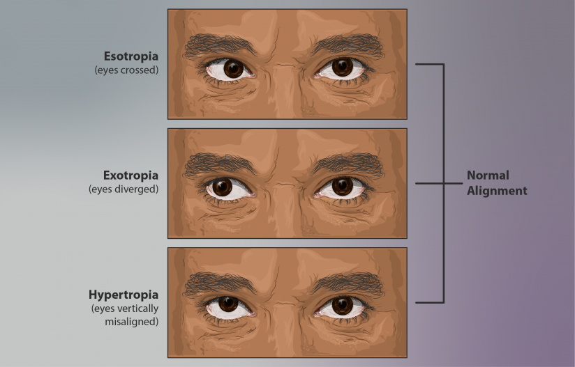 Strabismus and Amblyopia - PREP Duke Elder