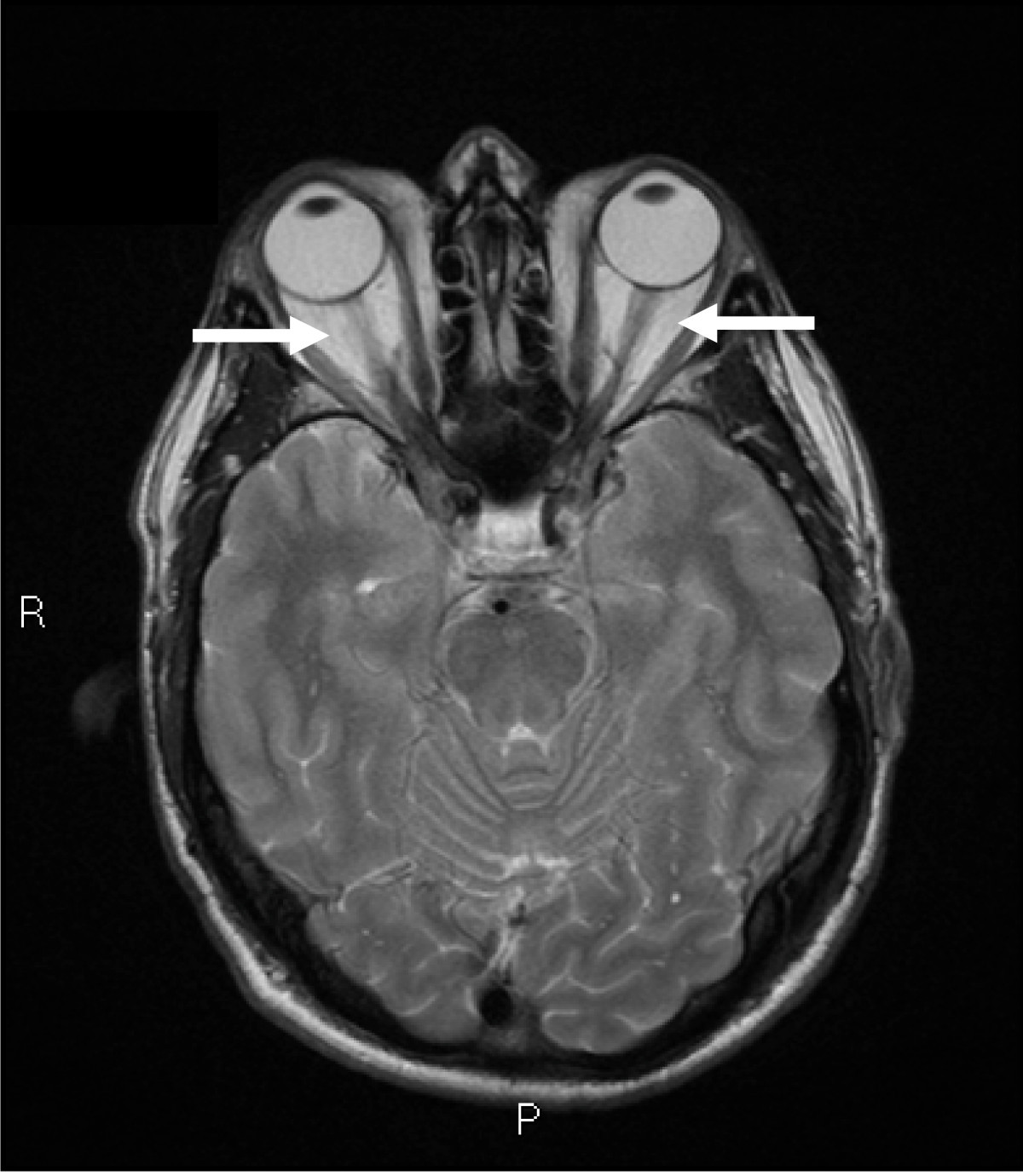 Orbital Inflammation - PREP Duke Elder
