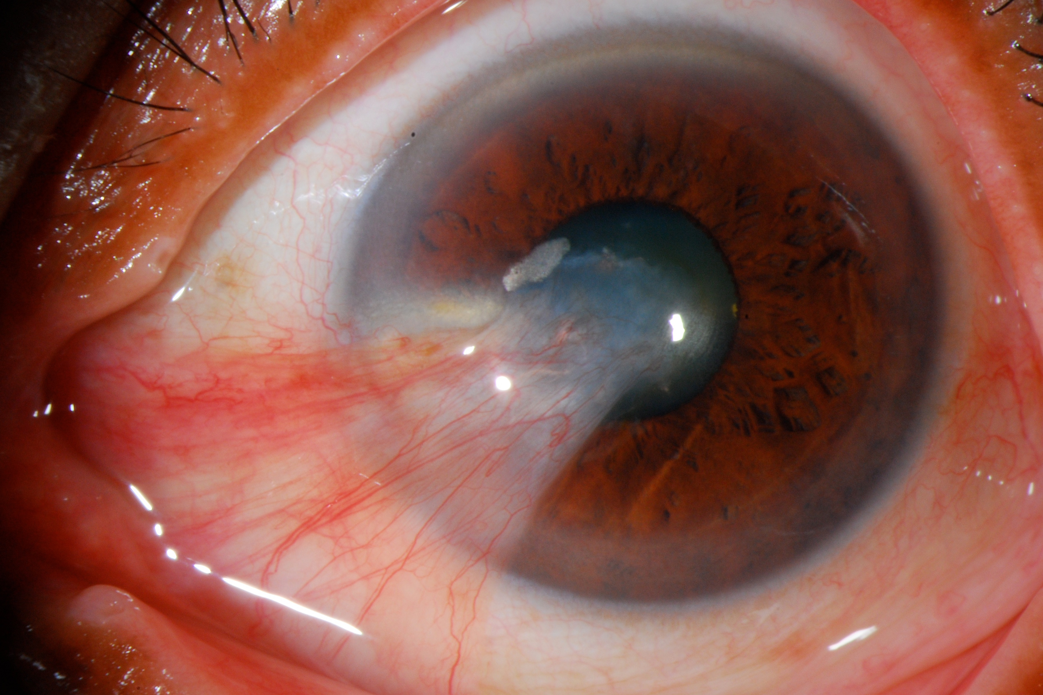 Other Disorders of the Conjunctiva - PREP Duke Elder