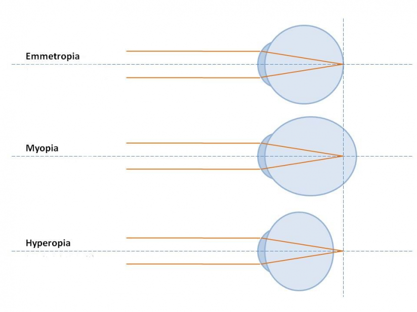 Refractive Errors - PREP Duke Elder