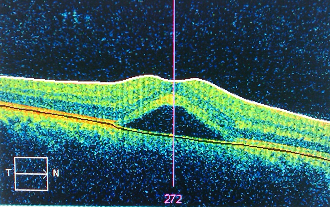 Acquired Macular Disease - PREP Duke Elder
