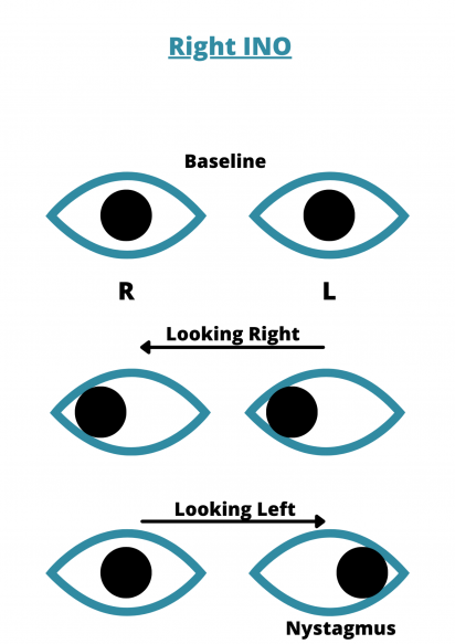 Gaze Abnormalities - PREP Duke Elder