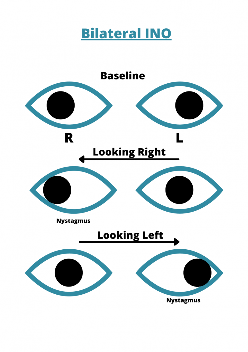 Gaze Abnormalities - PREP Duke Elder