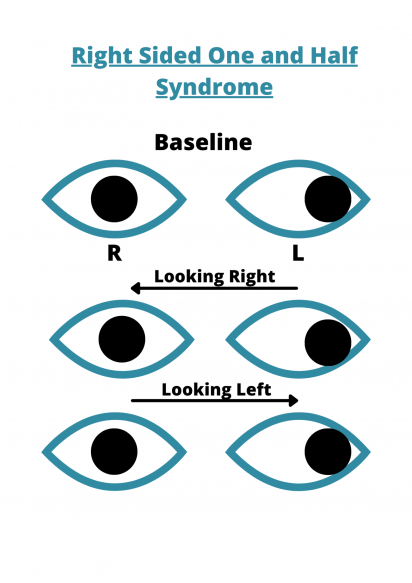 Gaze Abnormalities - PREP Duke Elder