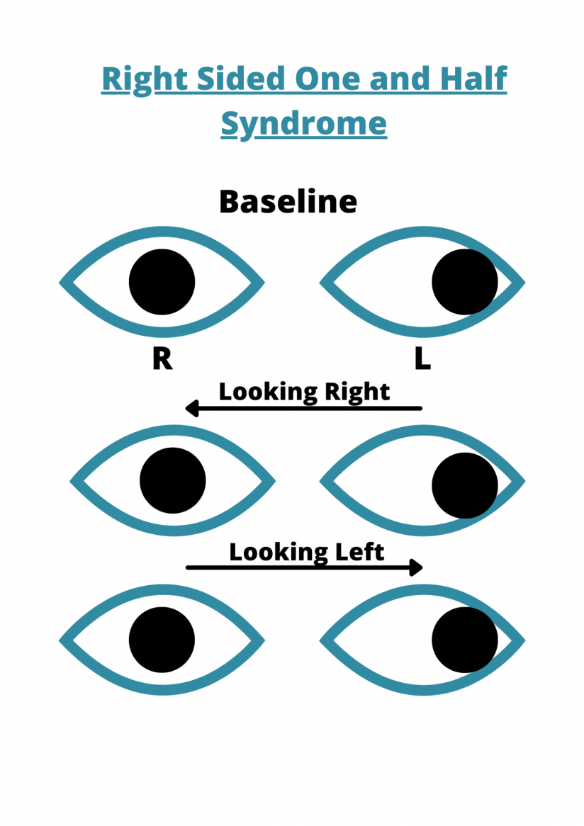 Gaze Abnormalities - PREP Duke Elder