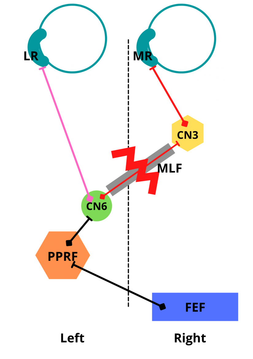 Gaze Abnormalities - PREP Duke Elder